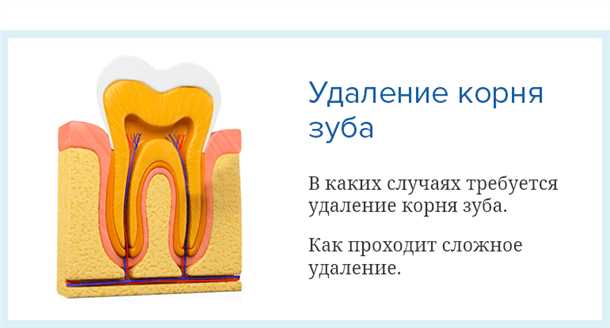 Процесс удаления корня зуба: шаг за шагом руководство | Медицинская ...